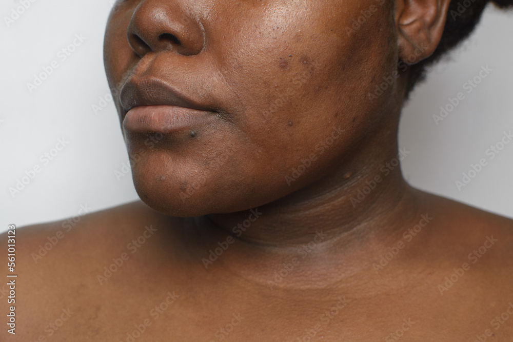 Brown skin with dark spots, hyperpigmentation on brown skin, african ...