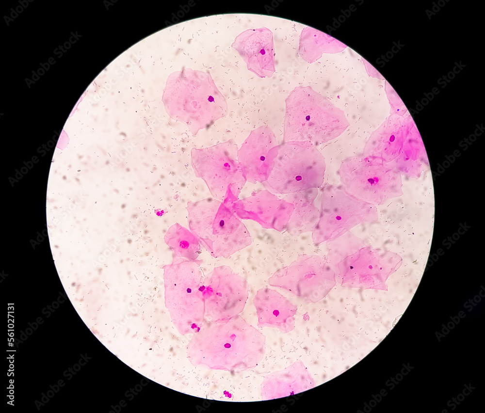 Photomicrograph of gram stain showing Bacterial Vaginosis Stock Photo ...