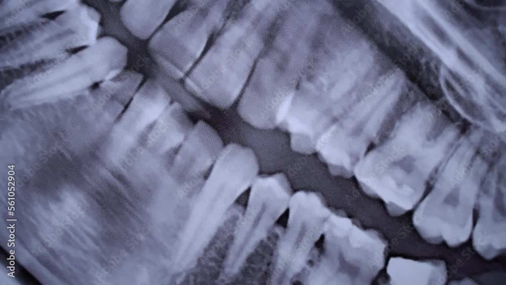 X-ray image of the jaw of all human teeth close-up. Magnetic resonance ...