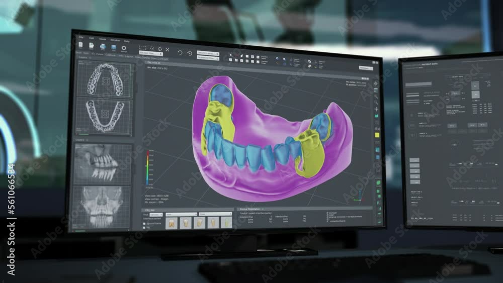Computer program inserting the artificial dental restorations inside ...
