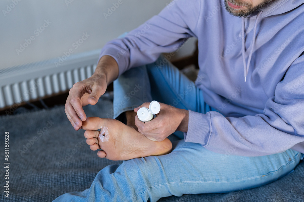 Man applies protective cream around wart plantar on his foot before ...
