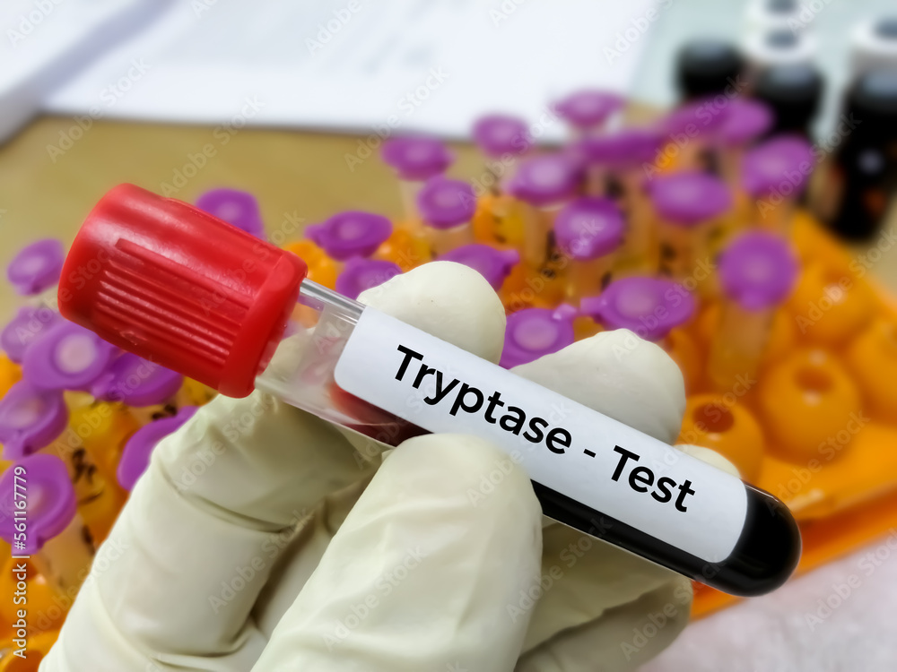 Blood sample for Tryptase test. A tryptase test can help doctors ...
