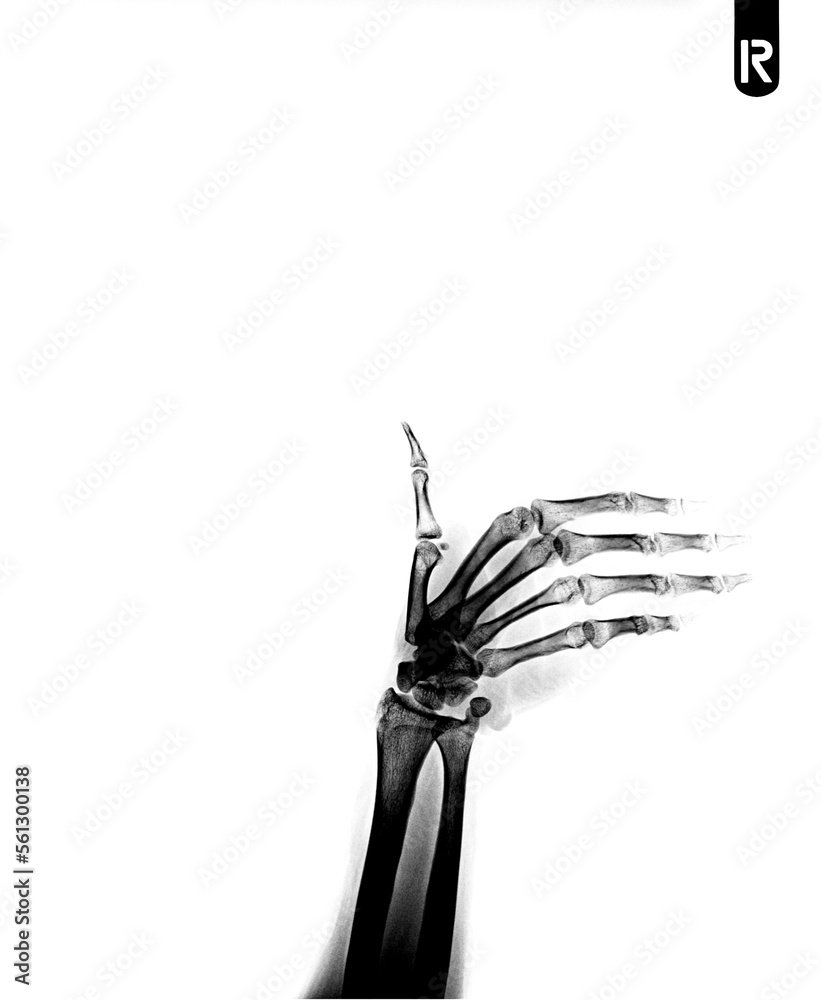 X-ray right hand ( anterior-posterior ) ( front view ) Stock Photo ...
