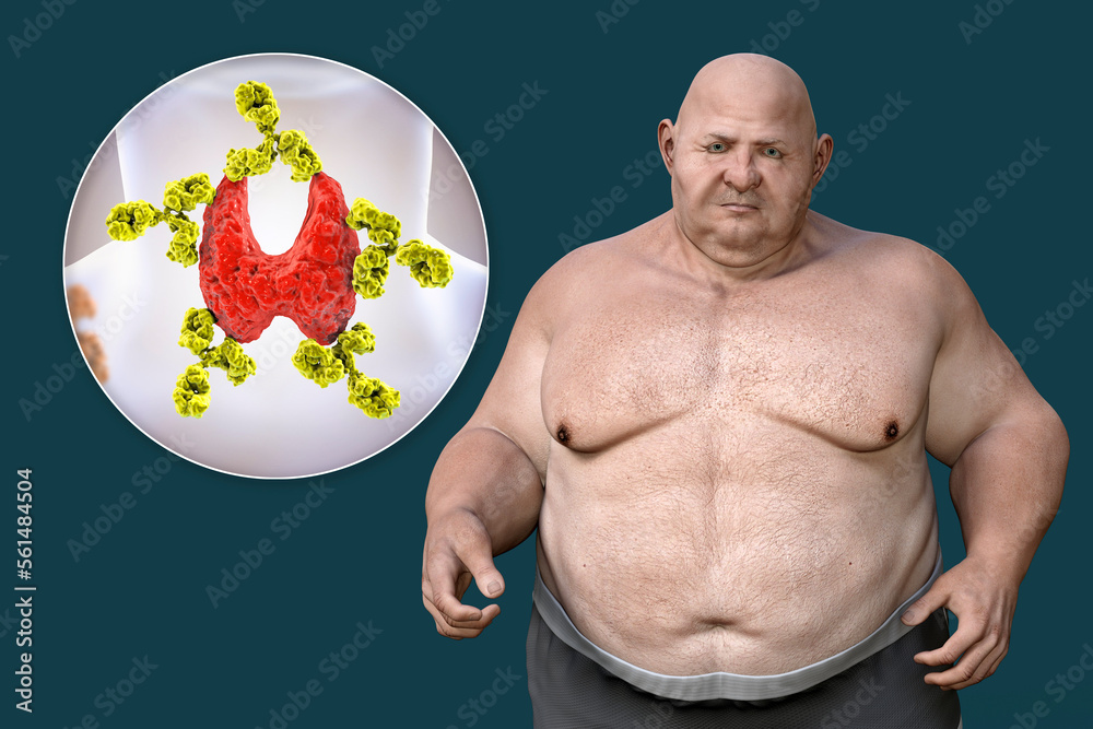 Autoimmune thyroiditis in obesity, conceptual 3D illustration showing ...