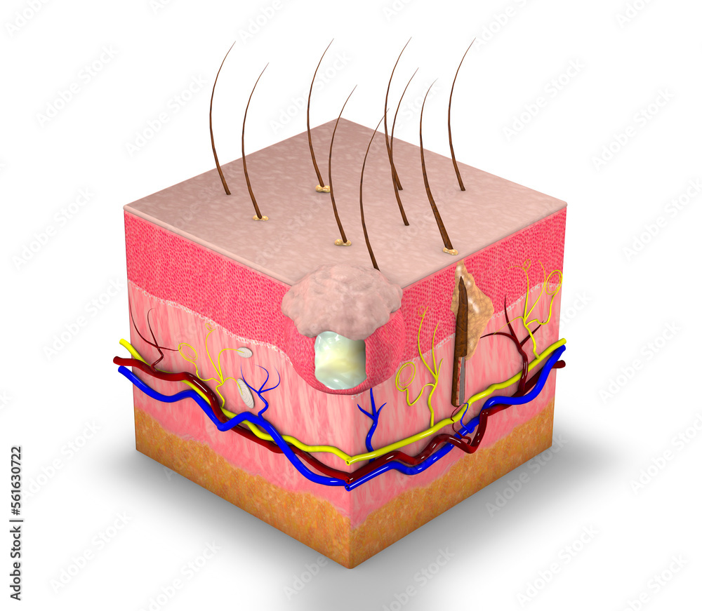 Section of skin with cyst, subcutaneous swelling. Pilar cyst and ...