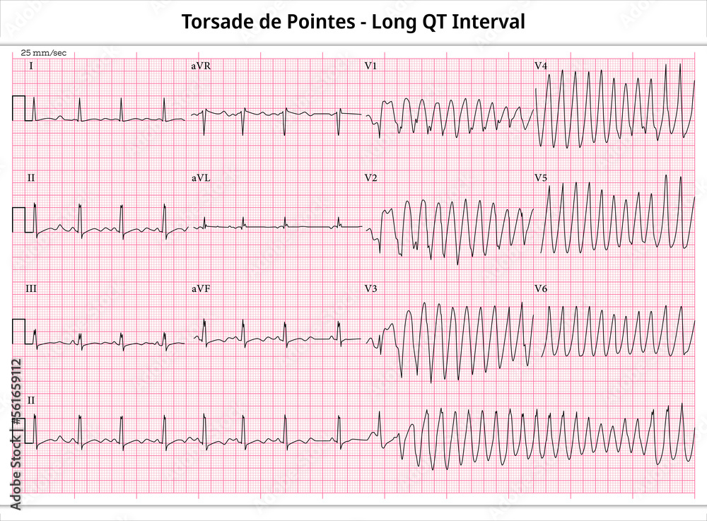 ECG Torsade de Pointes - Long QT Interval - Ventricular Tachycardia ...