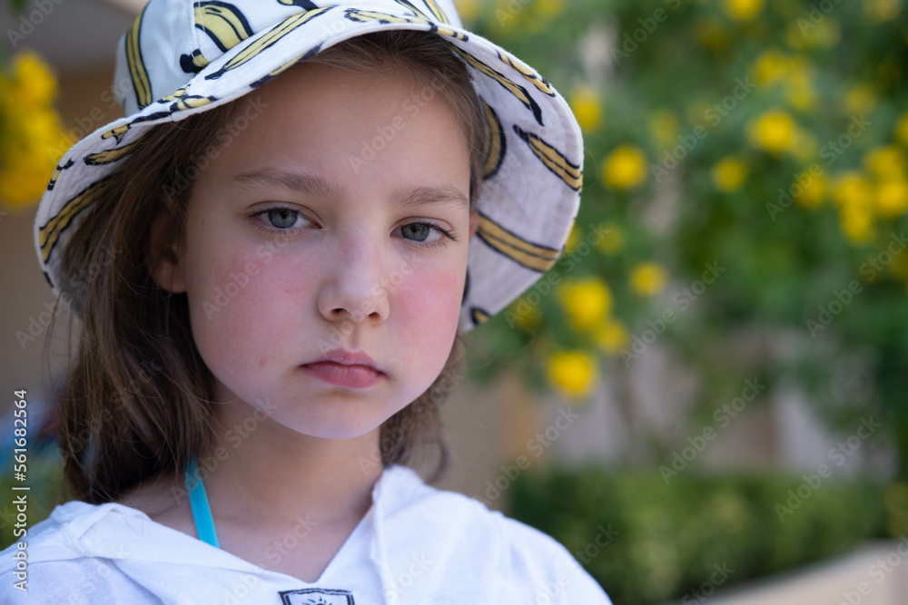 A girl with a painful hot sunburn, a problem of redness of the skin of ...