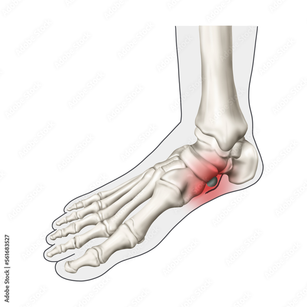 부주상골증후군 해부학 메디컬일러스트 Stock Illustration | Adobe Stock