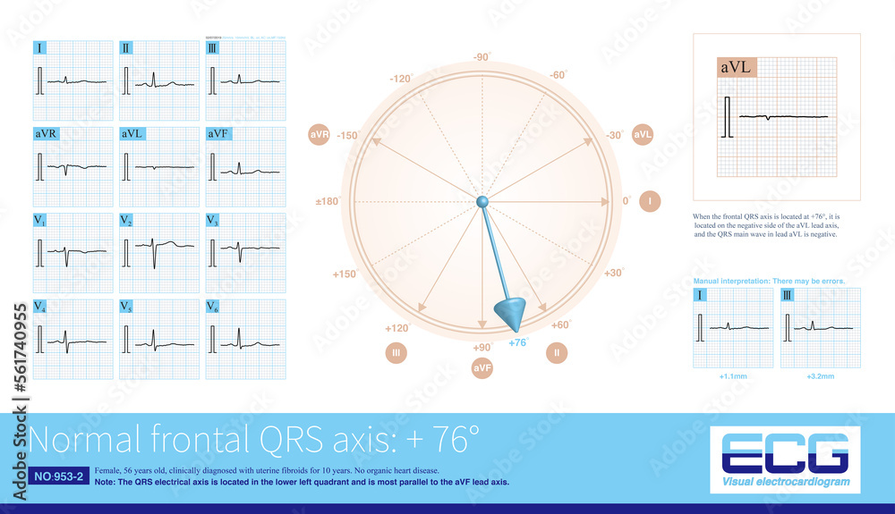 When the frontal QRS axis is located at +76°, it is located on the ...