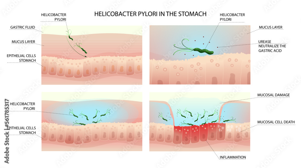Helicobacter pylori infection process in human stomach with gastritis ...