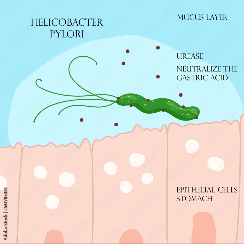 Helicobacter pylori in mucosal layer in stomach infographic Stock ...