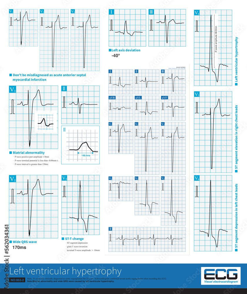 Left ventricular hypertrophy can cause a series of ECG changes such as ...