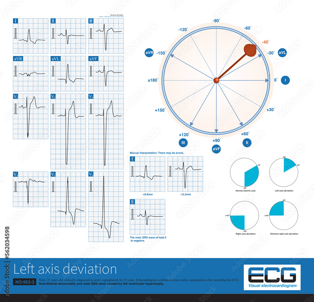 This is an electrocardiogram of left ventricular hypertrophy with left ...