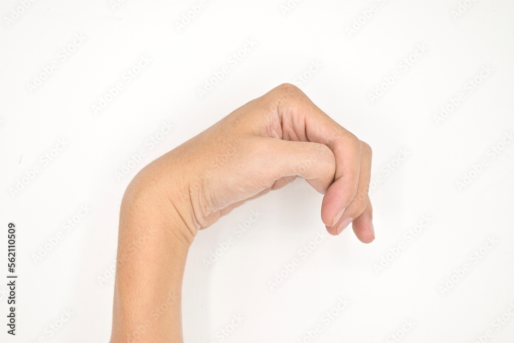 Cerebral palsy hand in Asian young male patient. Typically seen in ...