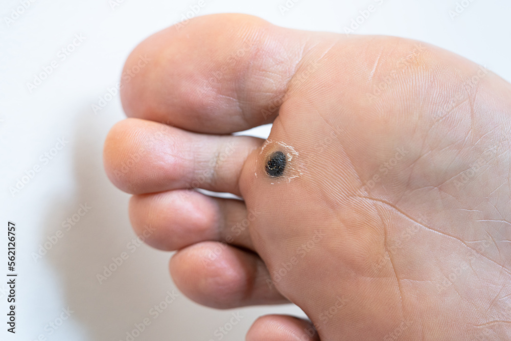 Closeup of dead skin around wart plantar after cauterizing it with ...