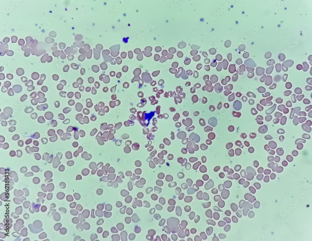 Microscopic view of hematological slide showing Pancytopenia. A ...