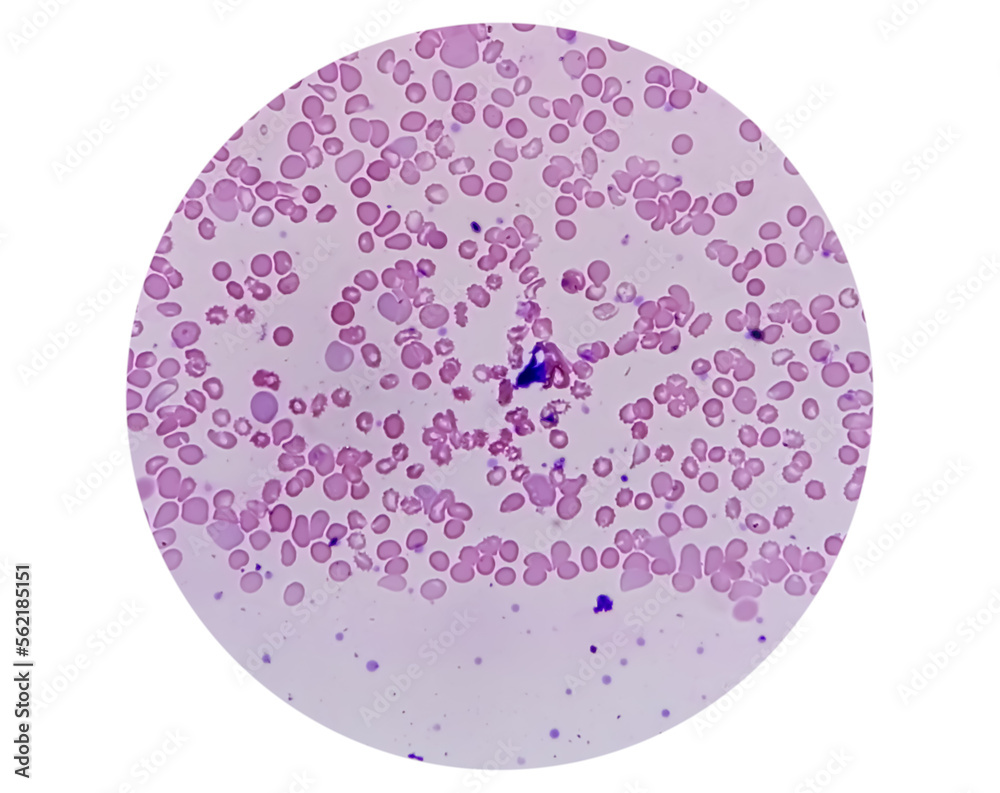 Microscopic view of hematological slide showing Pancytopenia. A ...
