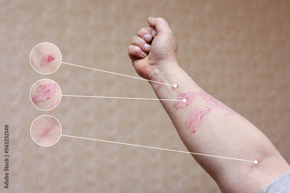 Foto de Macro detailed circles magnification psoriasis arm skin with ...