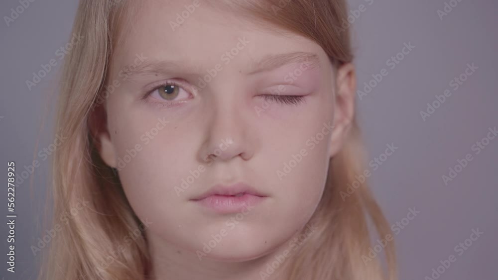 Close-up upset teen girl with a swollen and inflamed eye looks at the ...