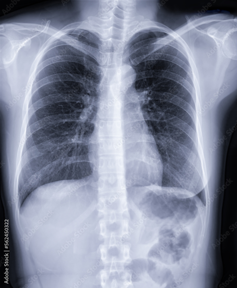 Chest x-ray image for screening diagnosis TB,tuberculosis and covid-19 ...