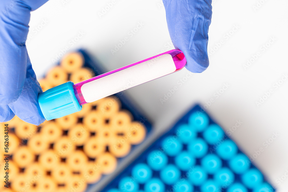 medical test tube with a blood sample in the doctor's hand against the ...