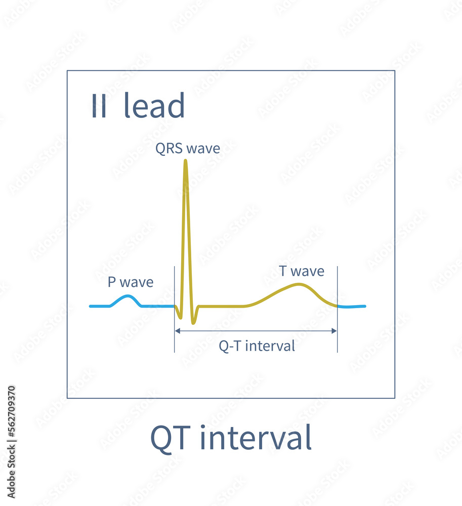 The QT interval of ECG is from the beginning of QRS wave to the end of ...
