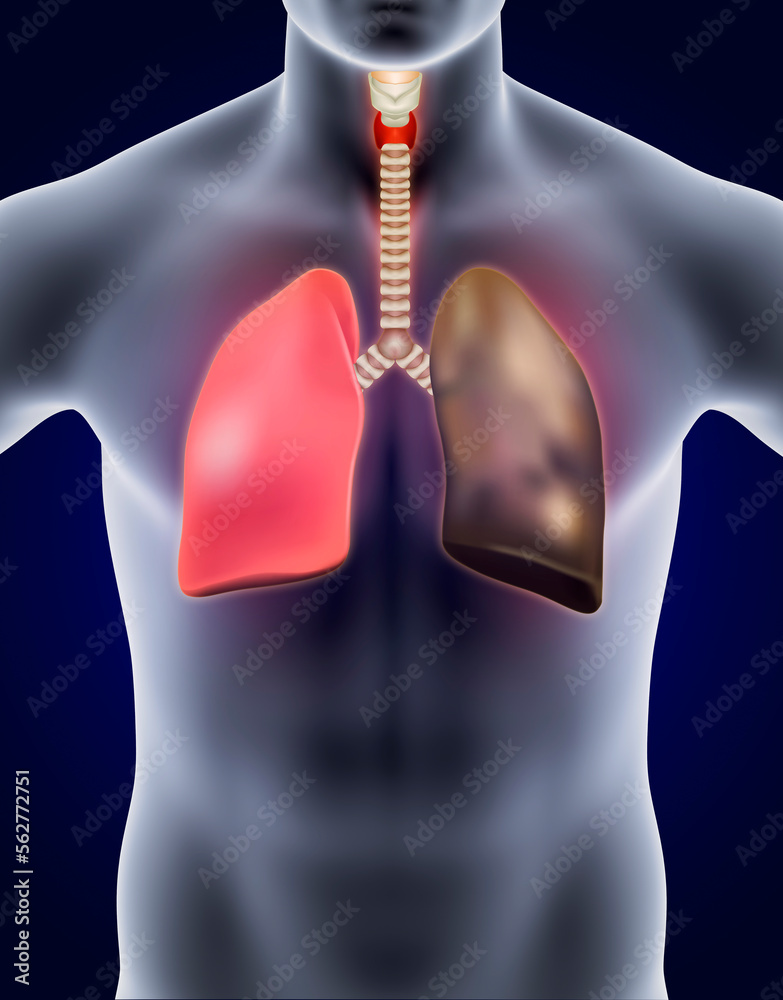 Lungs. Lung problems, tuberculosis, lung cancer. Digital and modern ...