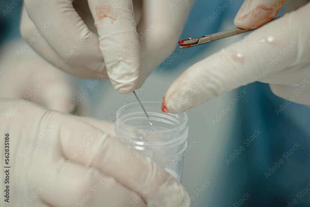 The surgeon puts the biopsy material into a container with a farmalin ...