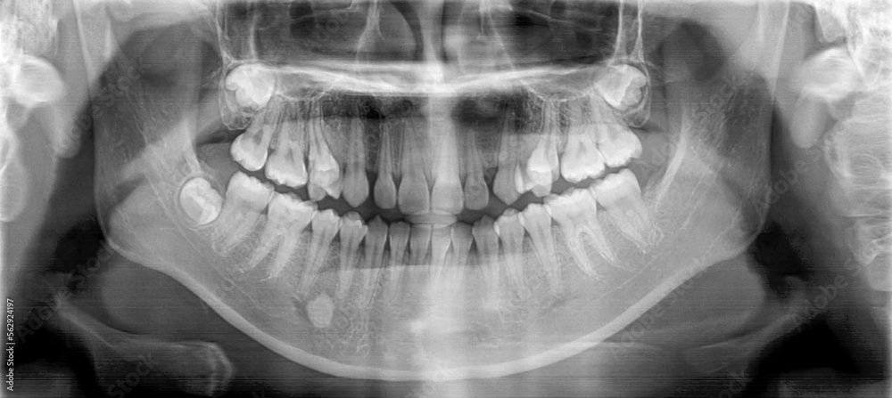 Film panoramic radiography view of the jaw.Multiple embedded and ...