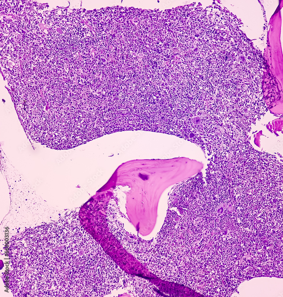 Non-Hodgkin lymphoma(Trephine biopsy tissue). Microscopically show ...