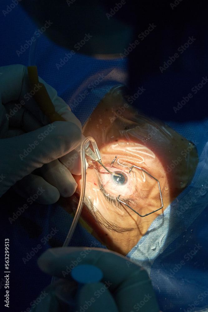 Phacoemulsification, destruction of the opaque lens by ultrasound ...