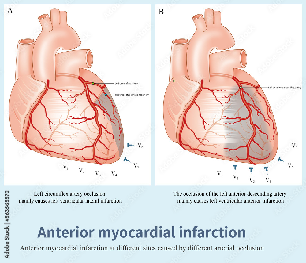 Left anterior descending artery occlusion causes left ventricular anterior infarction, and left ...