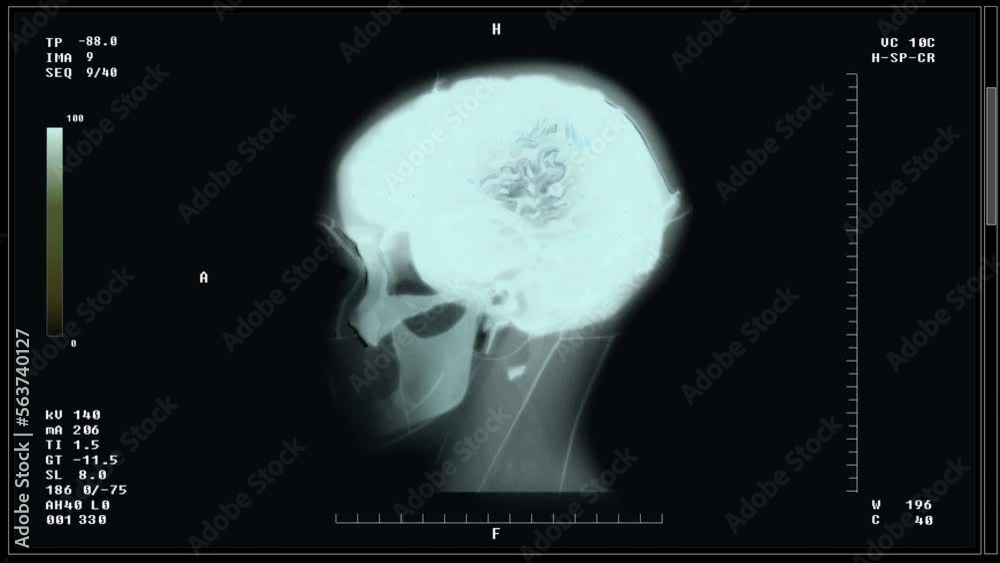 Vidéo Stock Medical Scanner Inspects Skull To Diagnose Abnormal Cancer ...