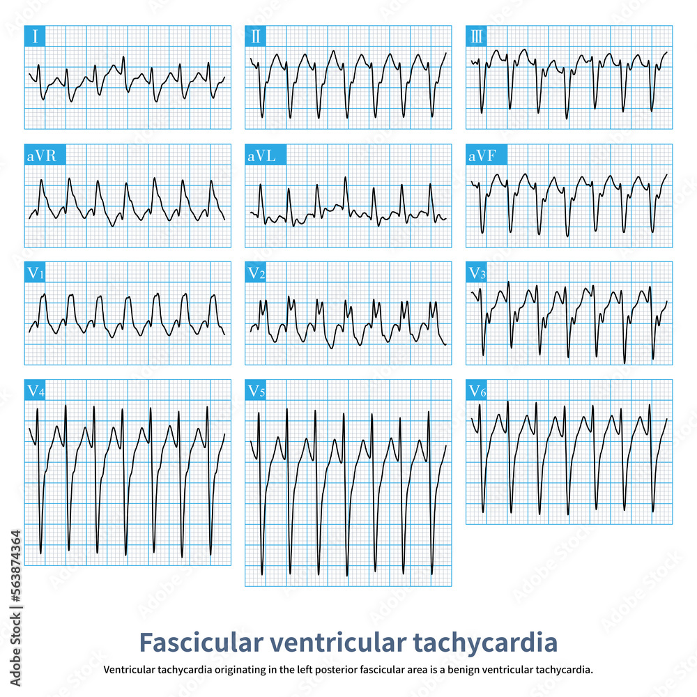 Ventricular tachycardia originating in the left posterior fascicular ...