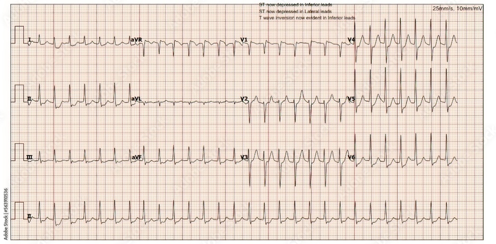 EKG show Supraventricular Tachycardia or SVT Stock Illustration | Adobe ...
