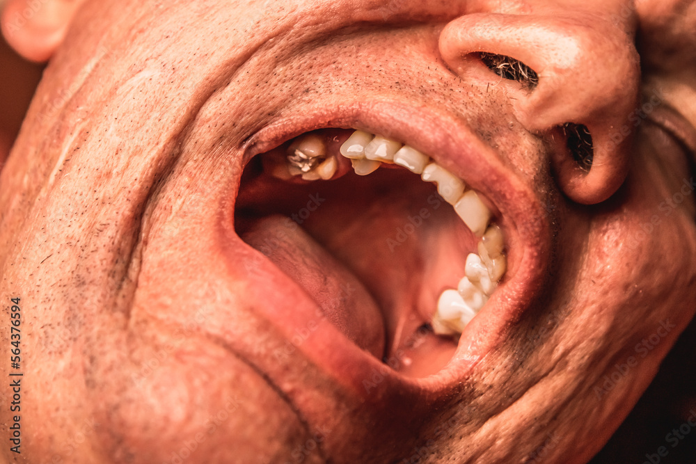 Close up man open mouth, jaw with teeth, detailed sealed tooth after ...
