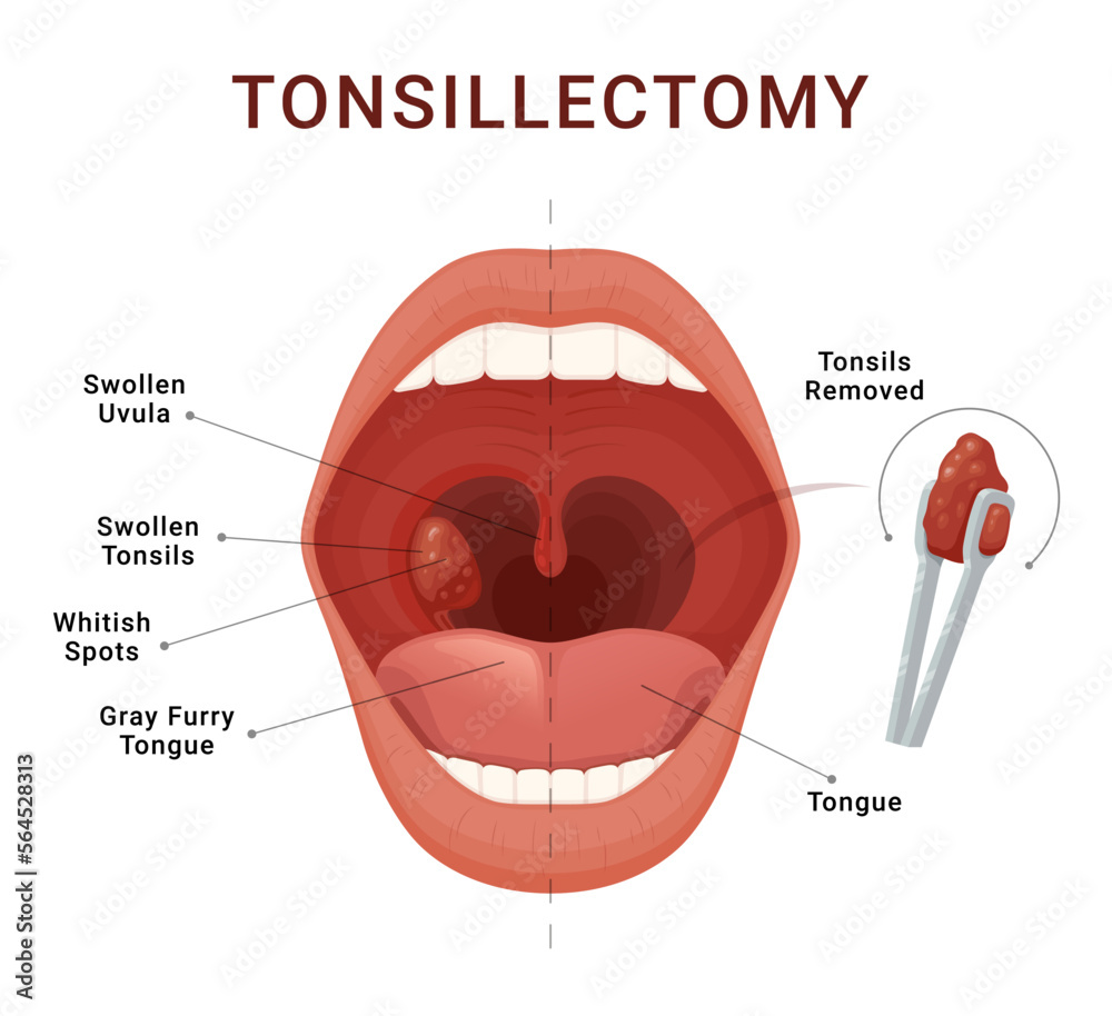 Tonsillectomy Scheme Removal Of Palatine Tonsils Acute Pharyngitis