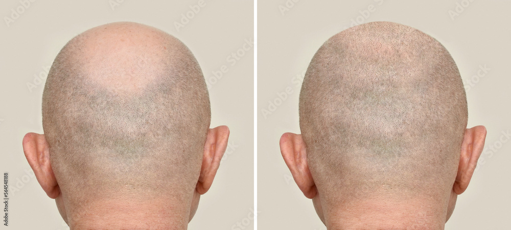 Bald man before and after hair transplantation. The head of a balding ...