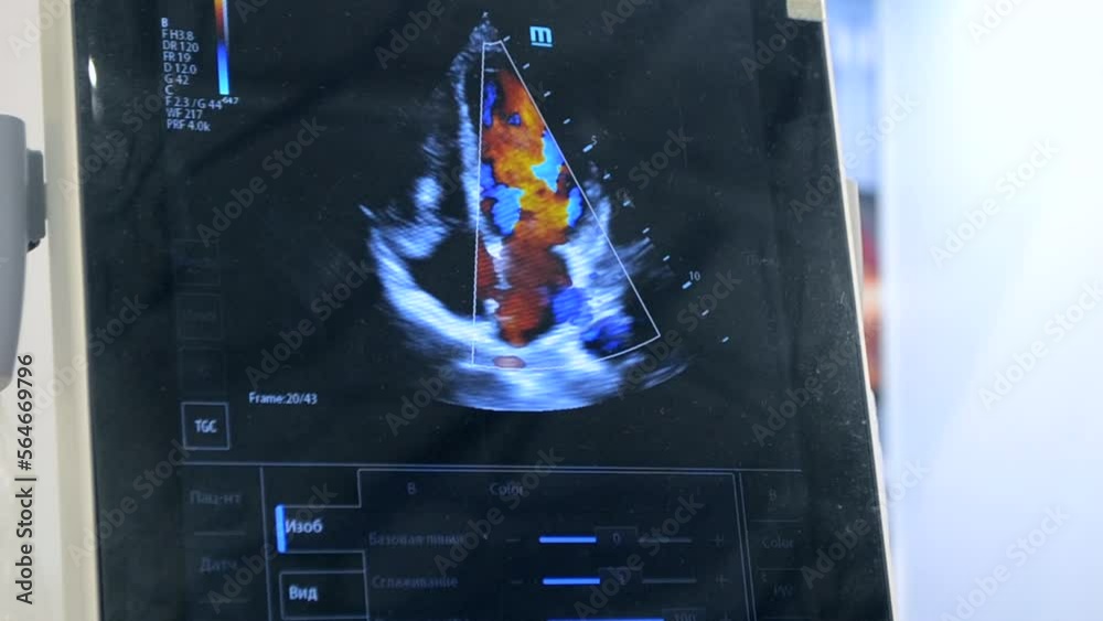 Utrasound image on the monitor close-up. Ultrasound Scan display ...