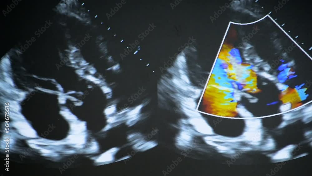 Utrasound image on the monitor close-up. Ultrasound Scan display ...
