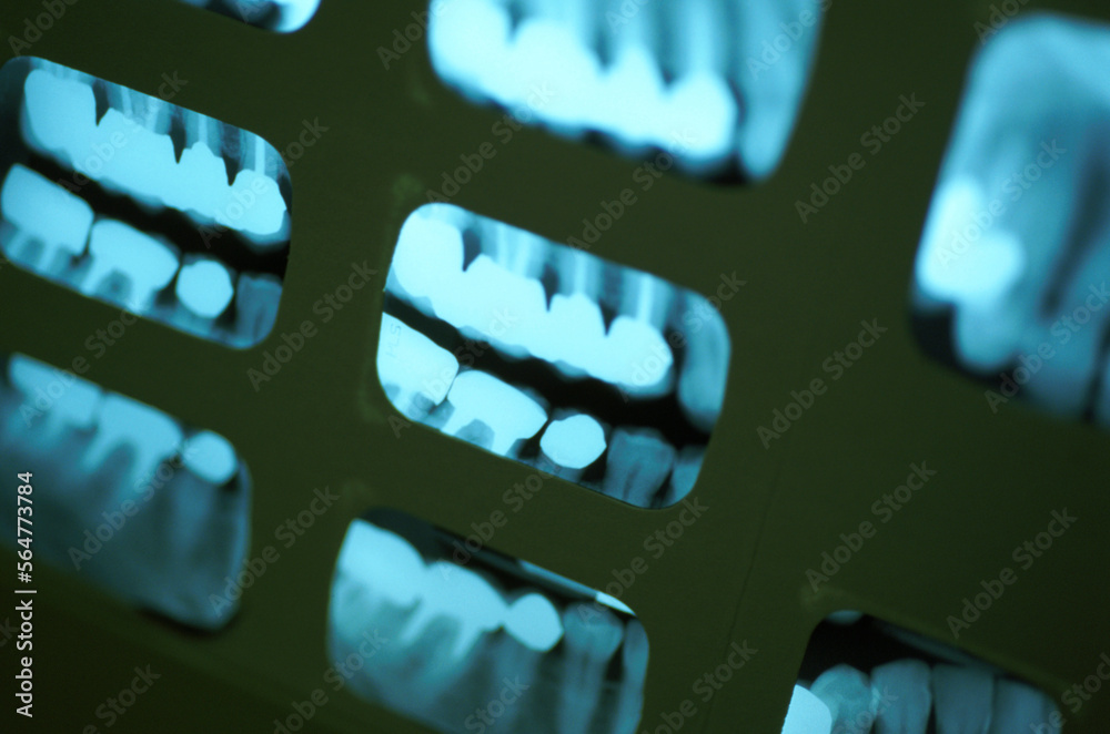 Full series mouth X-ray photo of teeth. Stock Photo | Adobe Stock