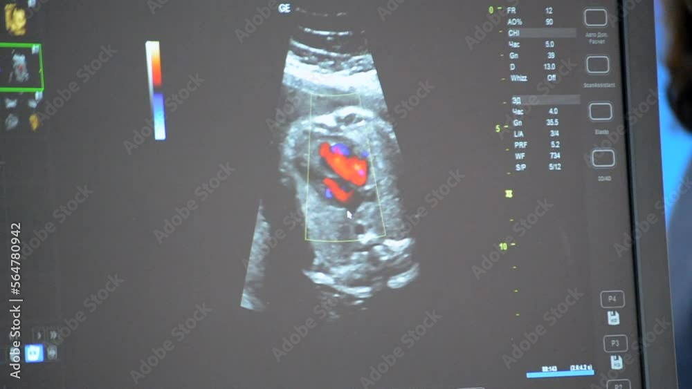 Utrasound image on the monitor close-up. Ultrasound Scan display ...
