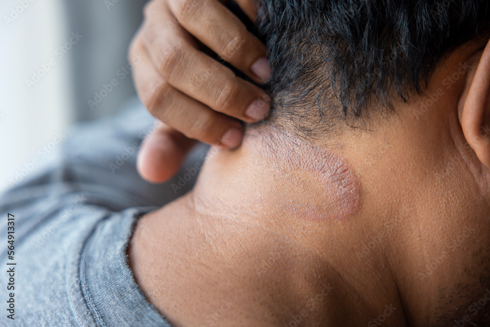Dark-skinned Asian men suffer from scalp dermatitis due to moisture ...