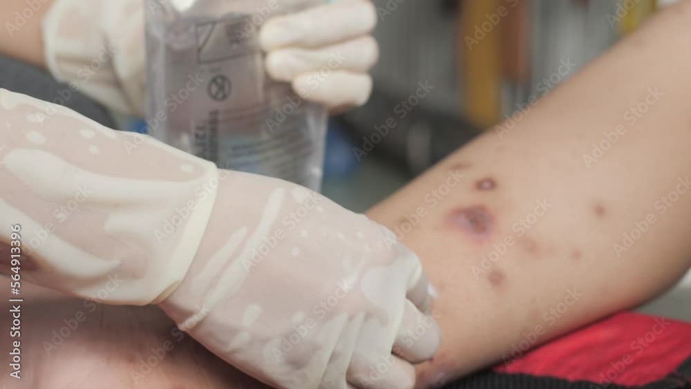 Nurse hand cleaning patient foot with ulcer filled with pus condition ...