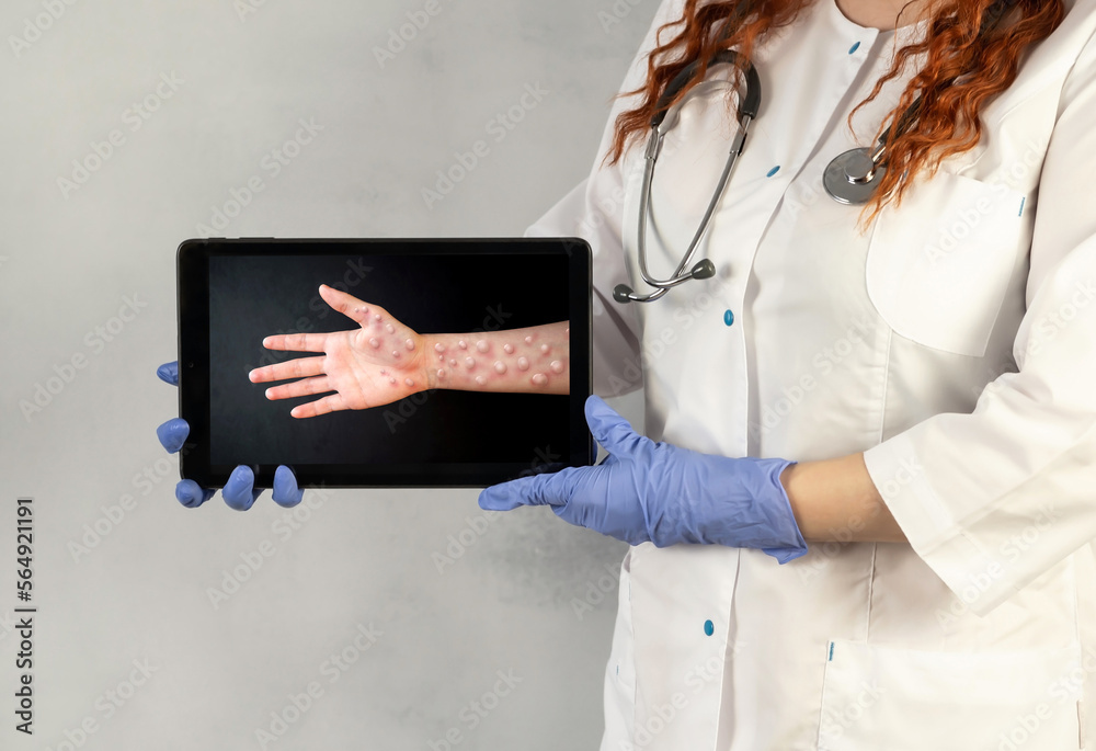 MONKEYPOX. The doctor is holding a tablet, a photo of a man with ...