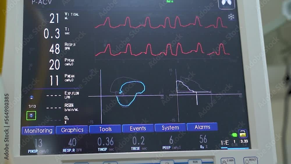 Stockvideon Neonatal Intensive Care Unit monitoring equipment monitors ...