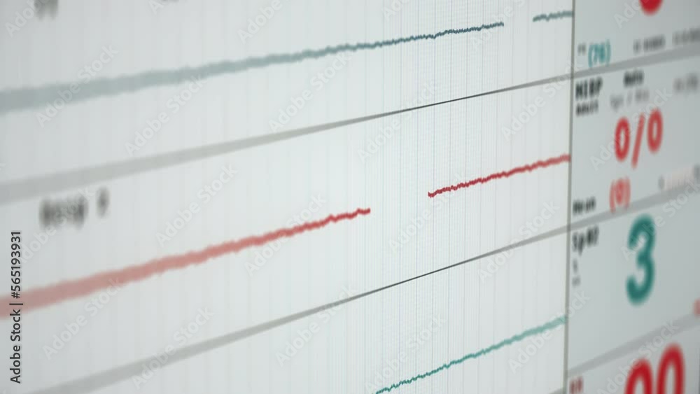 Heart rate testing equipment detects no data from the emergency patient ...