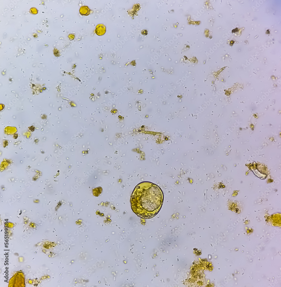 Microscopic examination of Stool showing Blastocystis hominis parasite ...