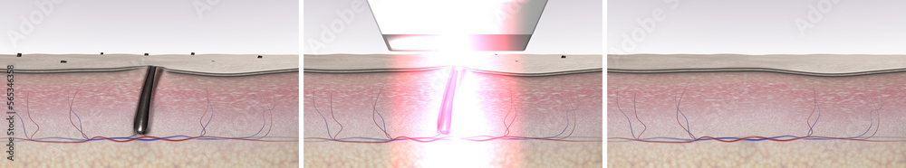 Laser Hair Removal Process 3d Rendered Illustration That Shows The 7932