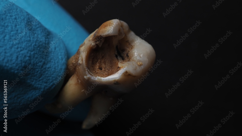 Tooth decay and dentist hand with glove and black background. Macro ...